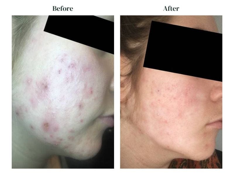 Acne & Functional Medicine | Clear Skin from Within